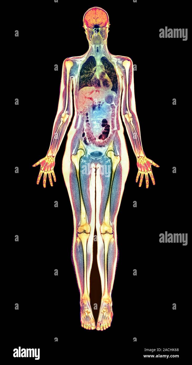 Thin woman, coloured magnetic resonance (MRI) scan. This coronal scan ...