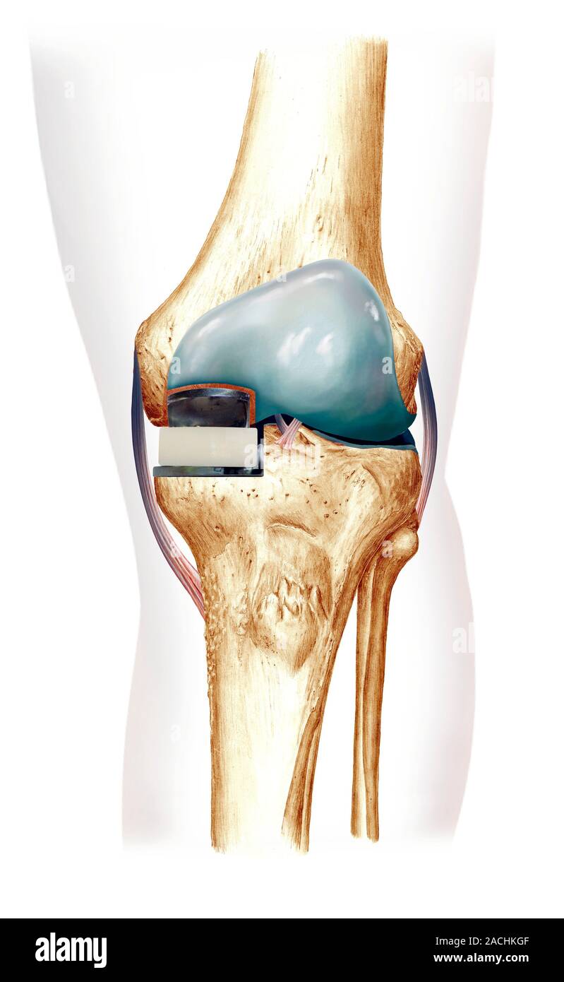 Partial knee replacement. Artwork of the bones and ligaments (right and ...