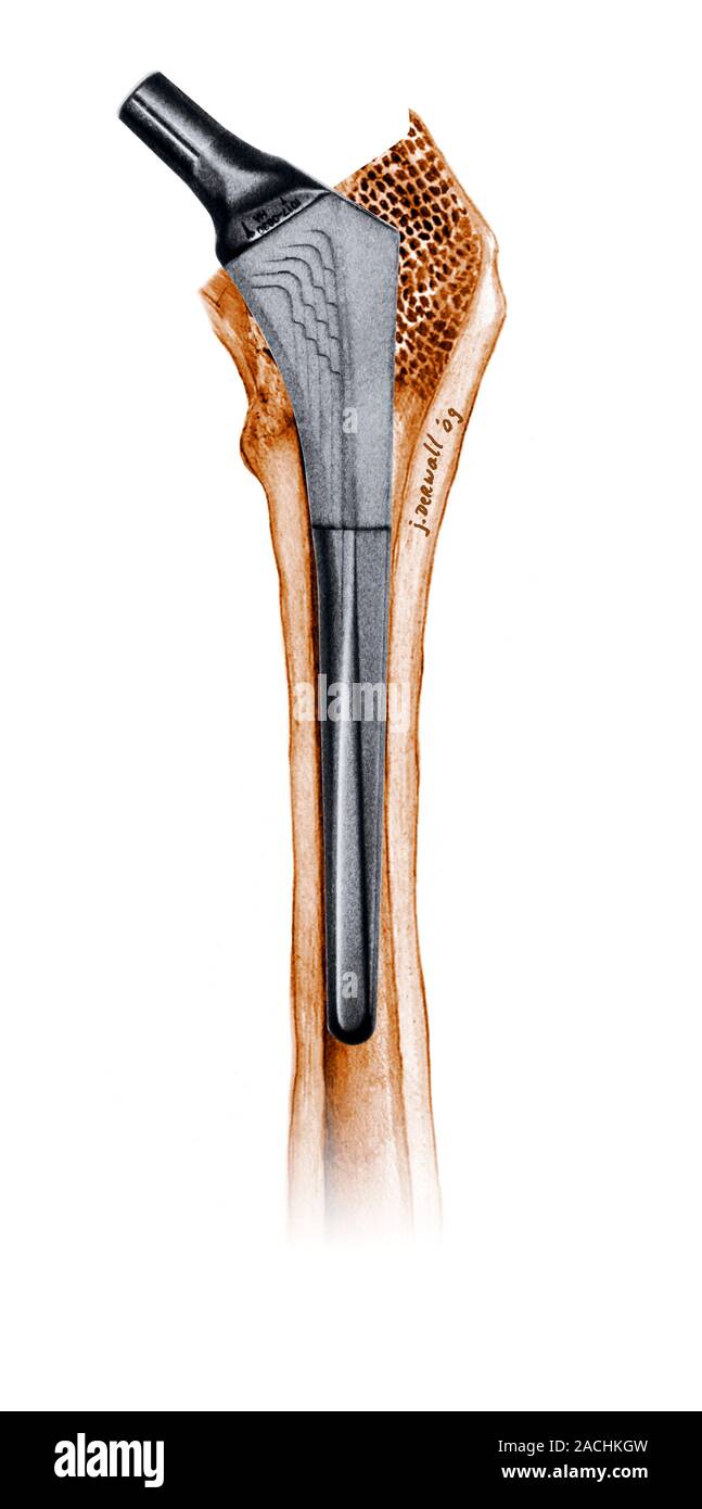 Prosthetic hip joint. Cutaway artwork of a femur (thigh bone) showing a ...