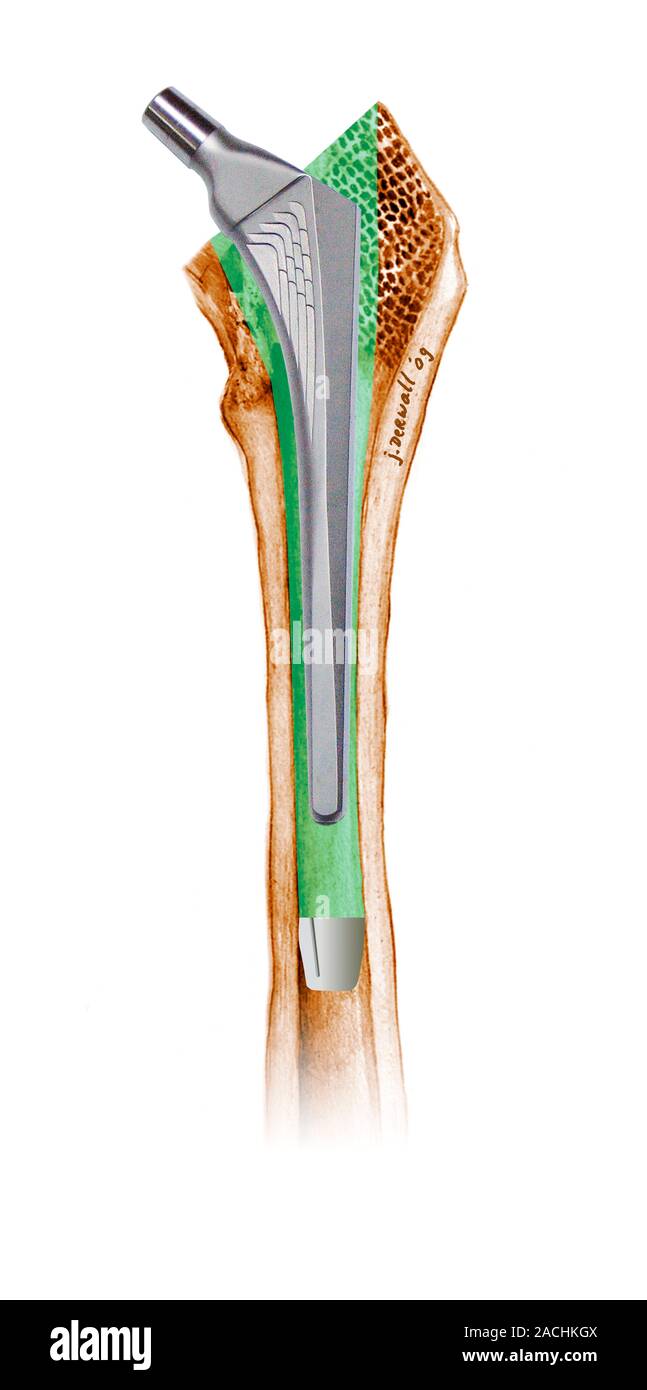 Prosthetic hip joint. Cutaway artwork of a femur (thigh bone) showing a ...