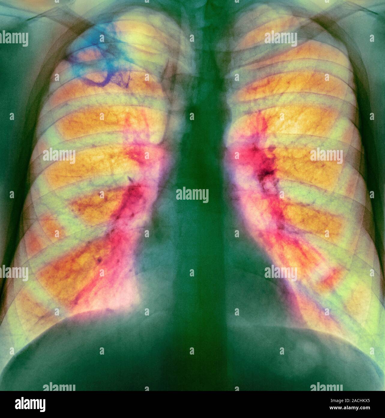 Coloured X-ray (front view) of the chest in a 29 year old male patient ...