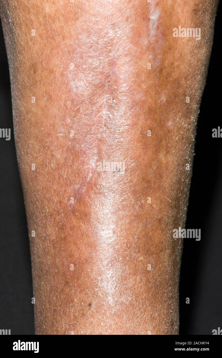 Close-up of the leg in a 70 year old male patient with varicose eczema ...