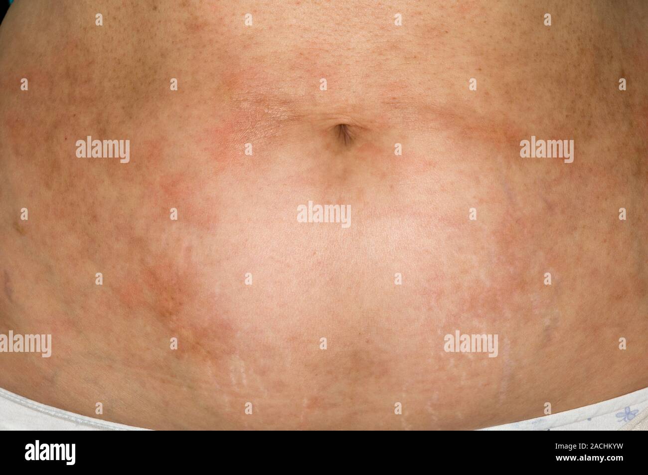 Rash On The Abdomen In A 54 Year Old Female Patient Due To Graft Versus Host Disease 10 Years