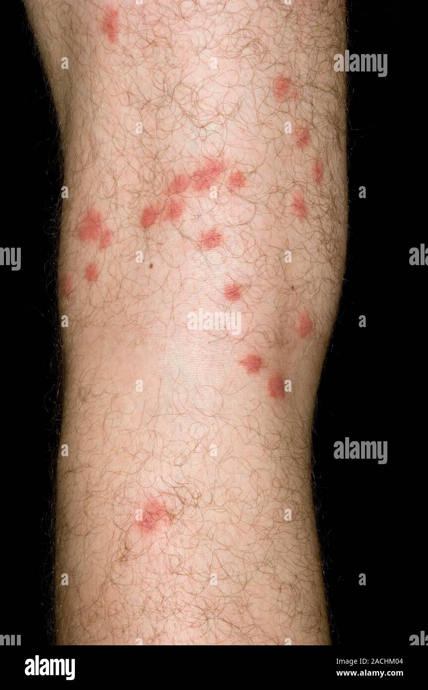 Close-up of the leg in a 17 year old male patient, showing an allergic ...