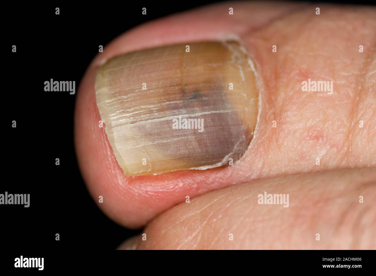 Close-up of the toenail in a 63 year old male patient with a fungal ...