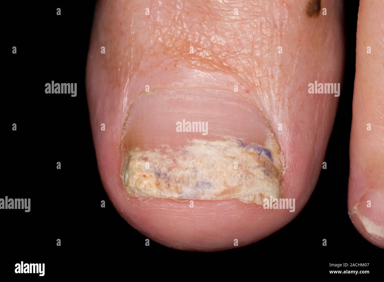 Close-up of the damaged toenail in a 58 year old female patient with a ...