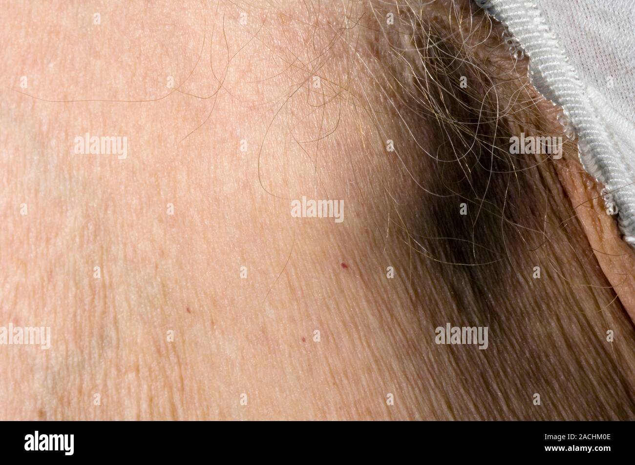 Swollen Groin Lymph Nodes Why Do My Lymph Nodes Swell? | Monitor