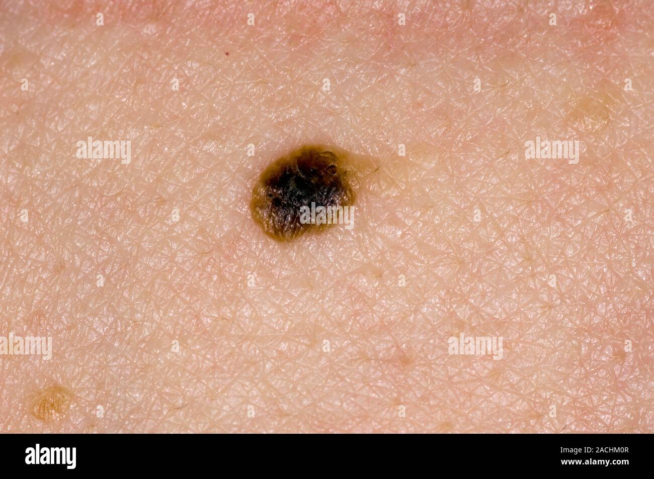 Close-up of a pigmented seborrheic wart on the skin in a 64 year old ...