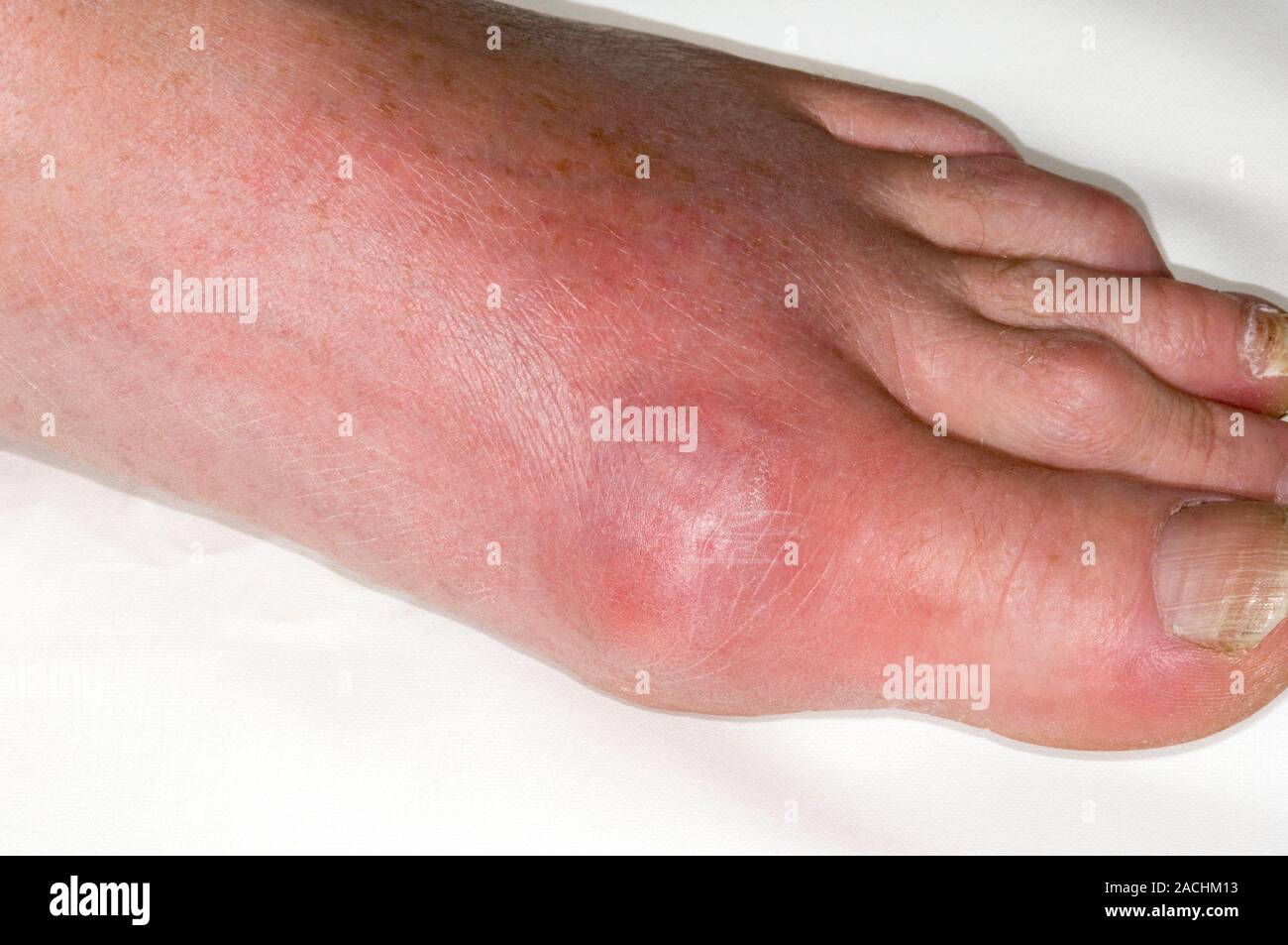 Close-up of the red and inflamed joint at the base of the big toe in a ...
