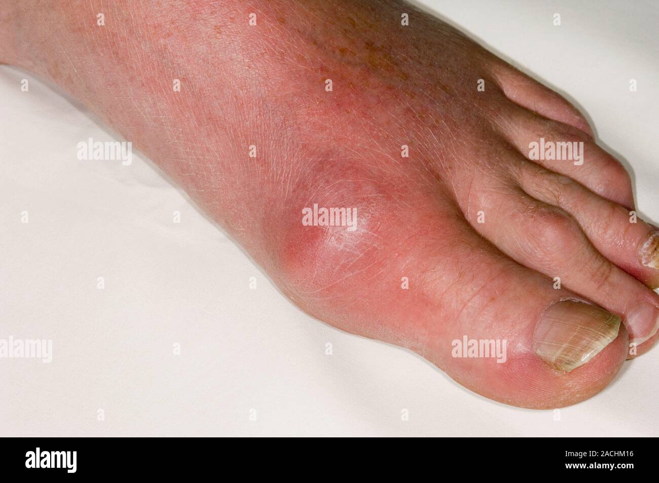 Close-up of the red and inflamed joint at the base of the big toe in a ...