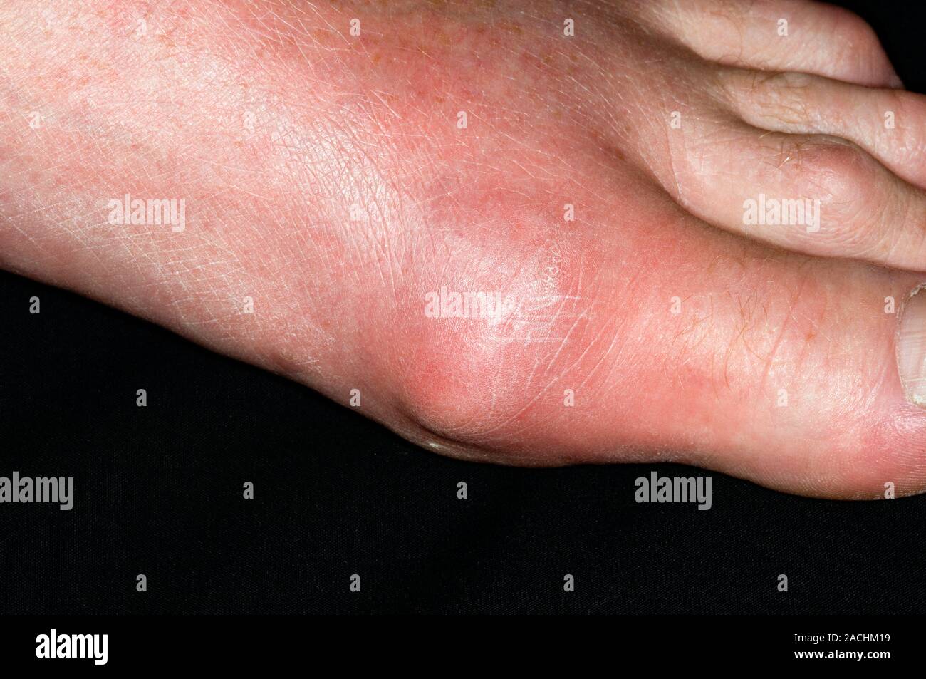 Close-up of the red and inflamed joint at the base of the big toe in a ...