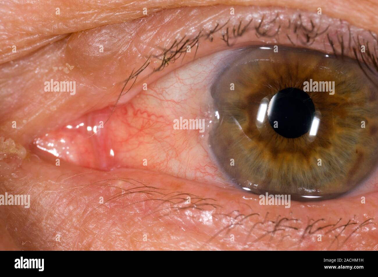 Close-up of the eye in a 71 year old male patient showing a pterygium ...