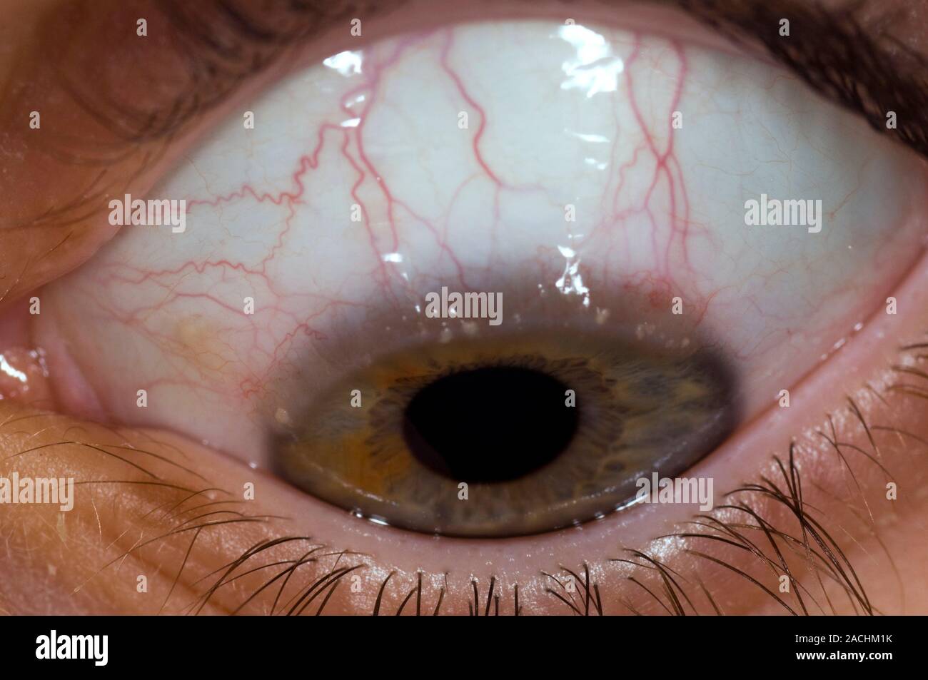 Close-up of the red veined eye in a 9 year old male patient showing ...
