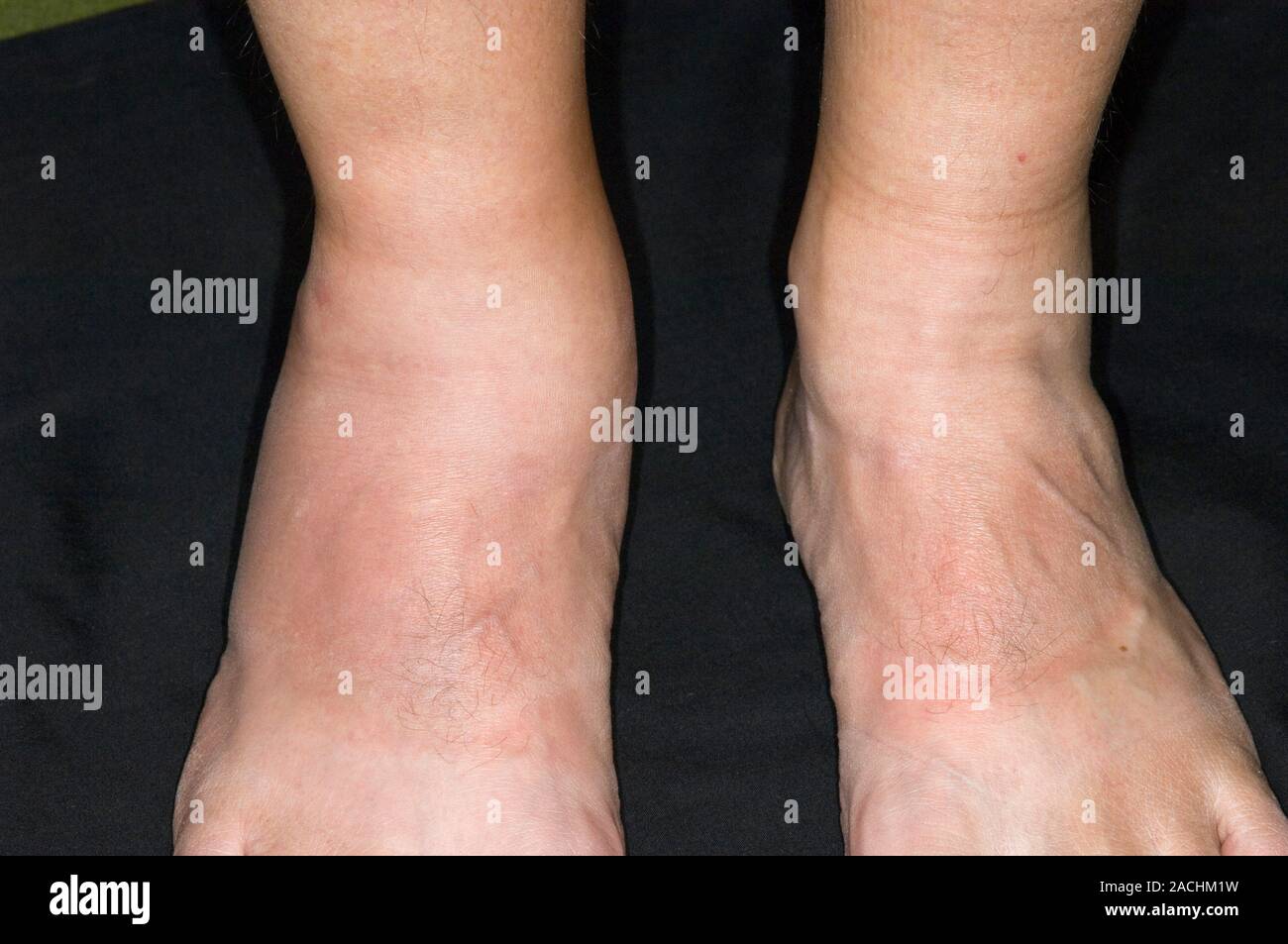 View of the swollen ankle joint (at left) in a 45 year old male patient ...