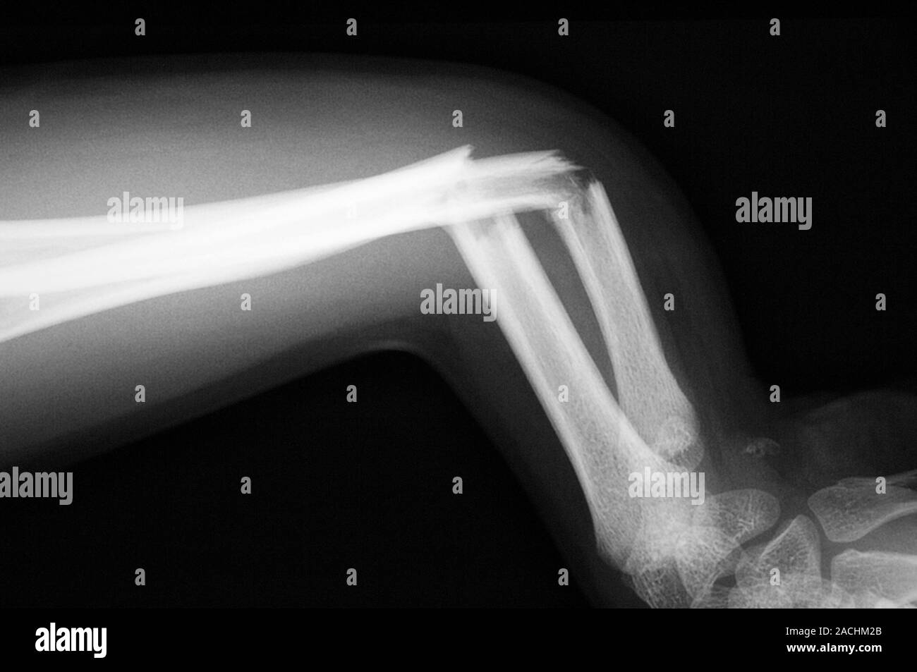 X-ray of the fractured radius and ulna bones of the arm in a 10 year ...