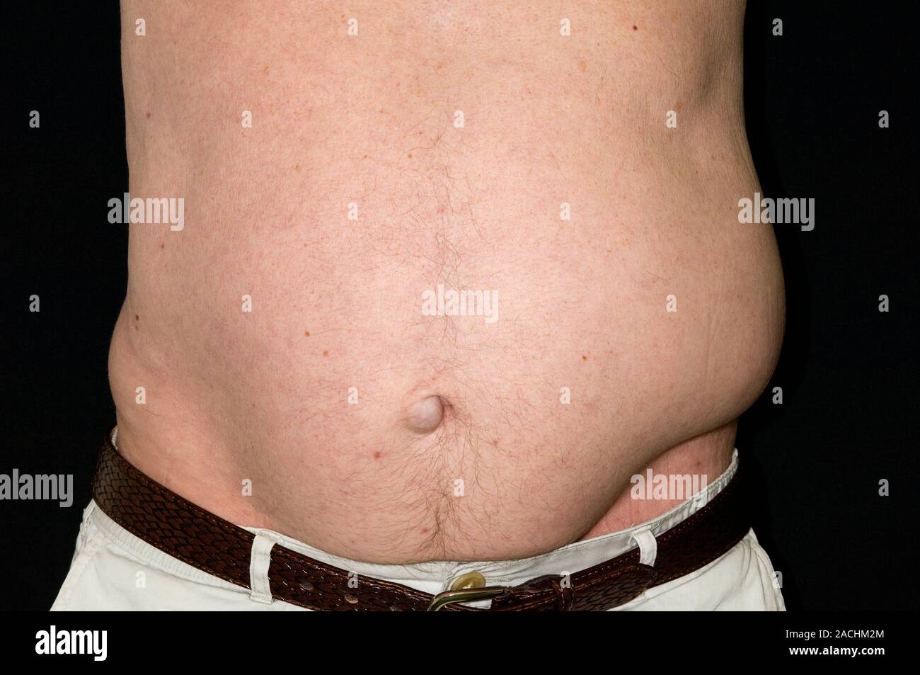 Weak abdominal wall. View of the abdomen in a 70 year old male patient ...