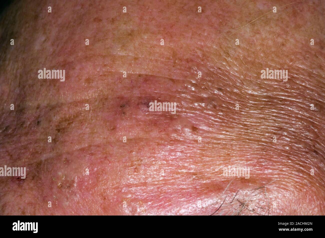 Close-up of a shingles rash on the forehead in a 72 year old male ...