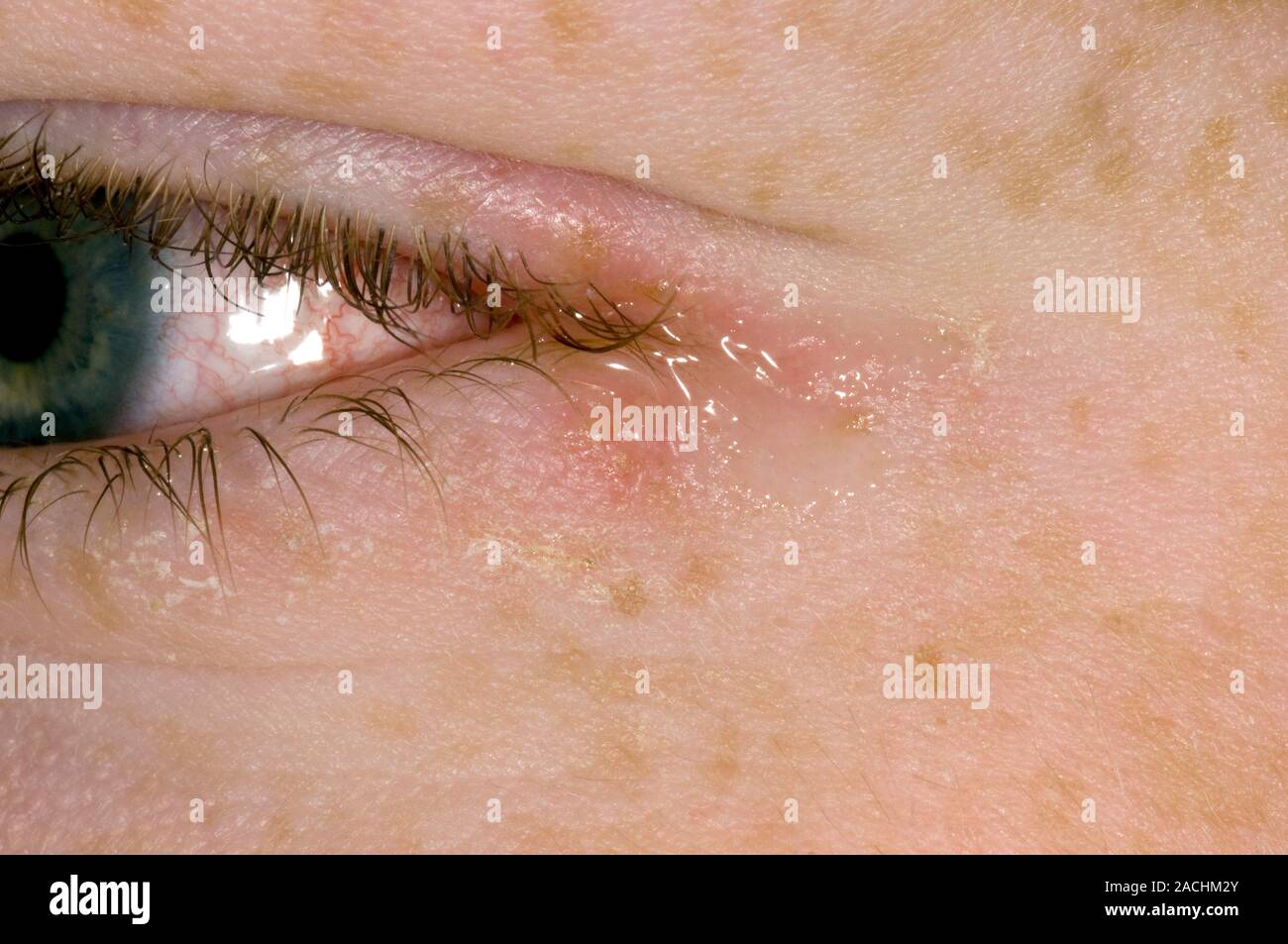 Close-up of a lesion (cold sore) at the corner of the eye in a 20 year ...