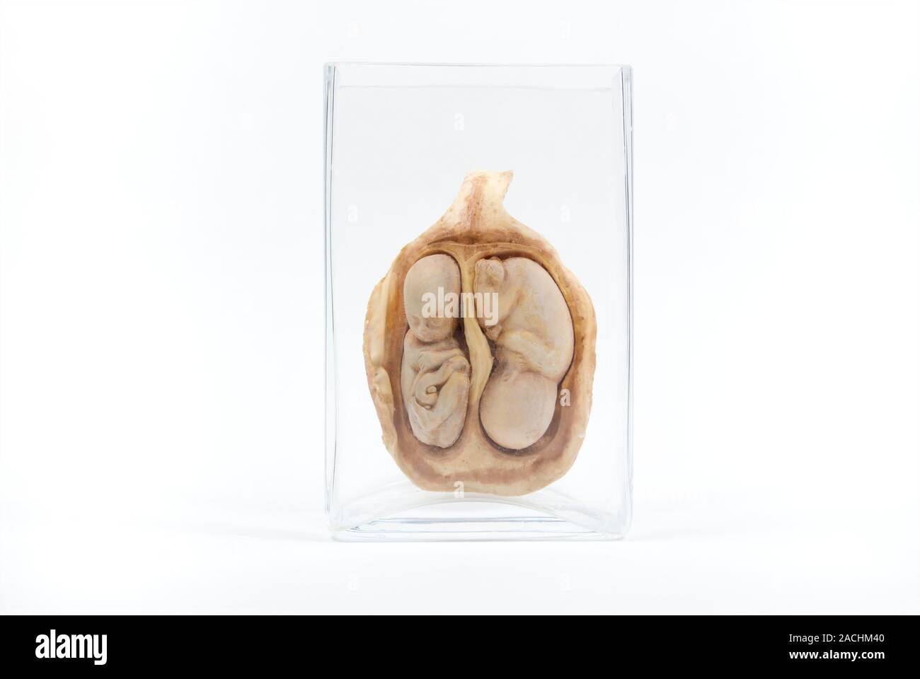 Twin foetuses. Model of twin foetuses in the uterus in a jar Stock ...