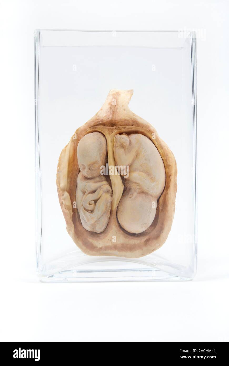 Twin foetuses. Model of twin foetuses in the uterus in a jar Stock ...