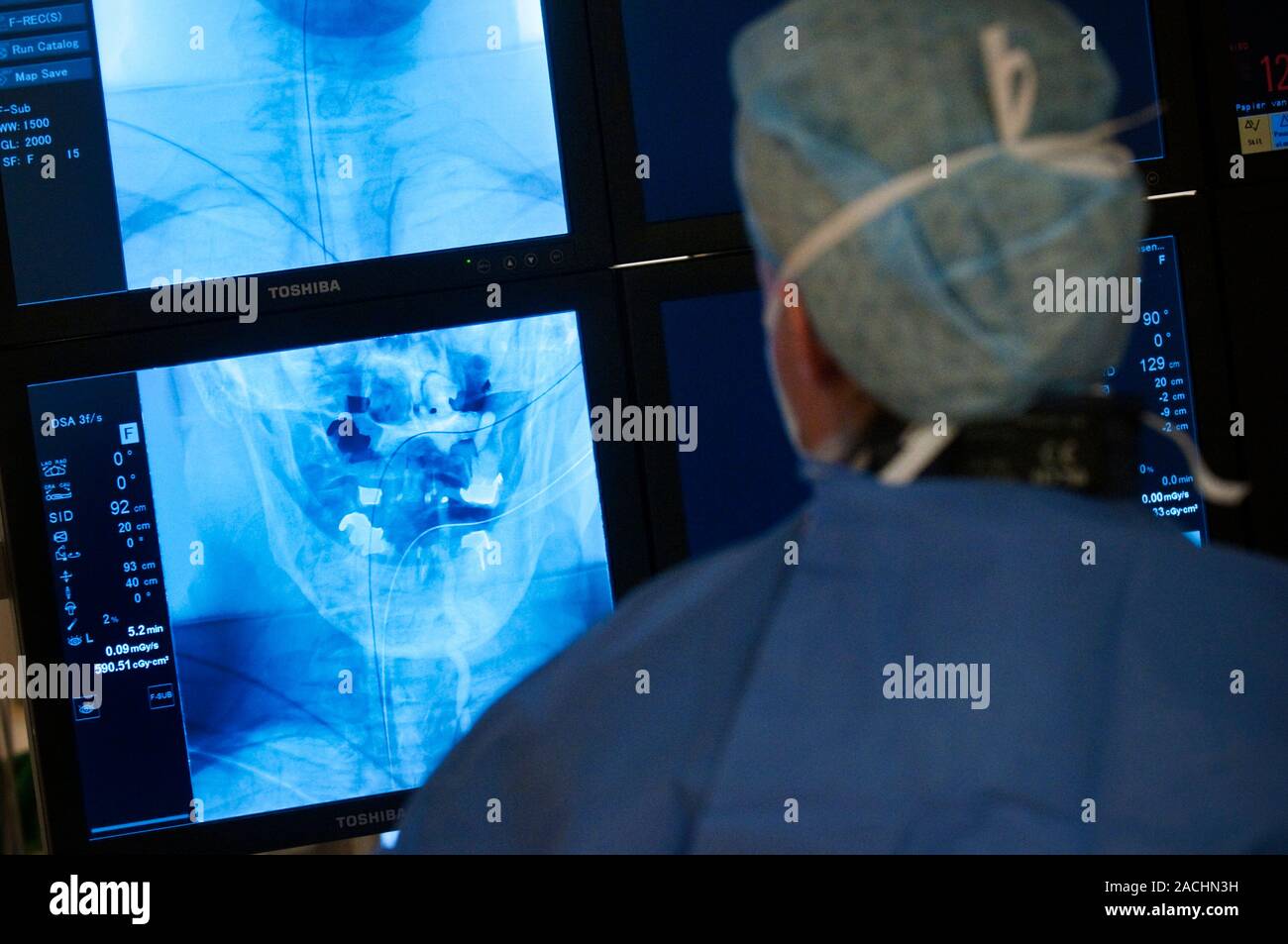 Aneurysm surgery. Surgeon removing an aneurysm in a patient's brain ...
