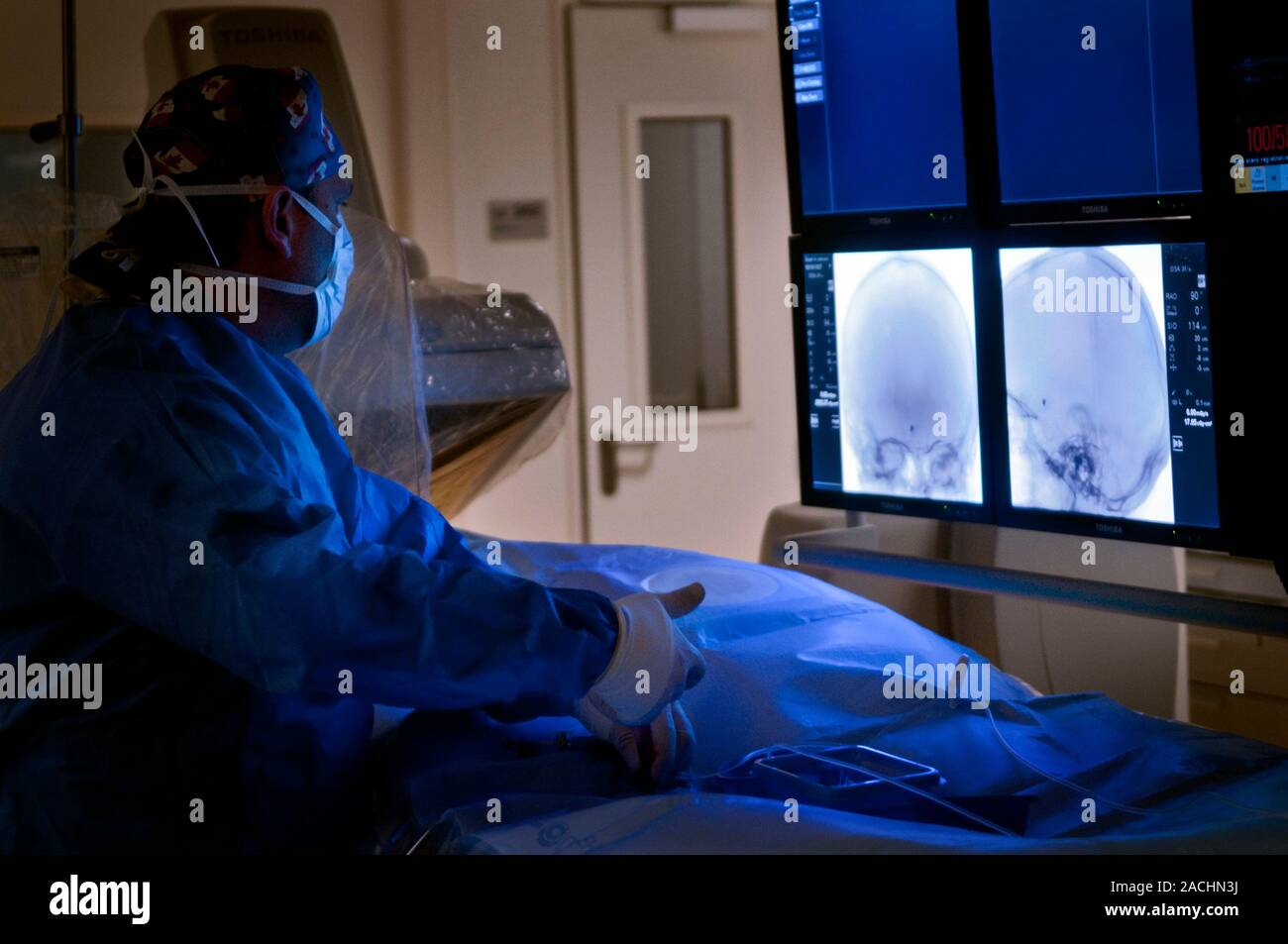 Aneurysm surgery. Surgeon removing an aneurysm in a patient's brain ...