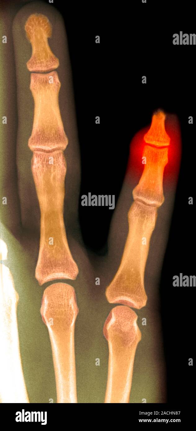Amputated fingertip. Coloured X-ray of the 4th and 5th fingers of a ...