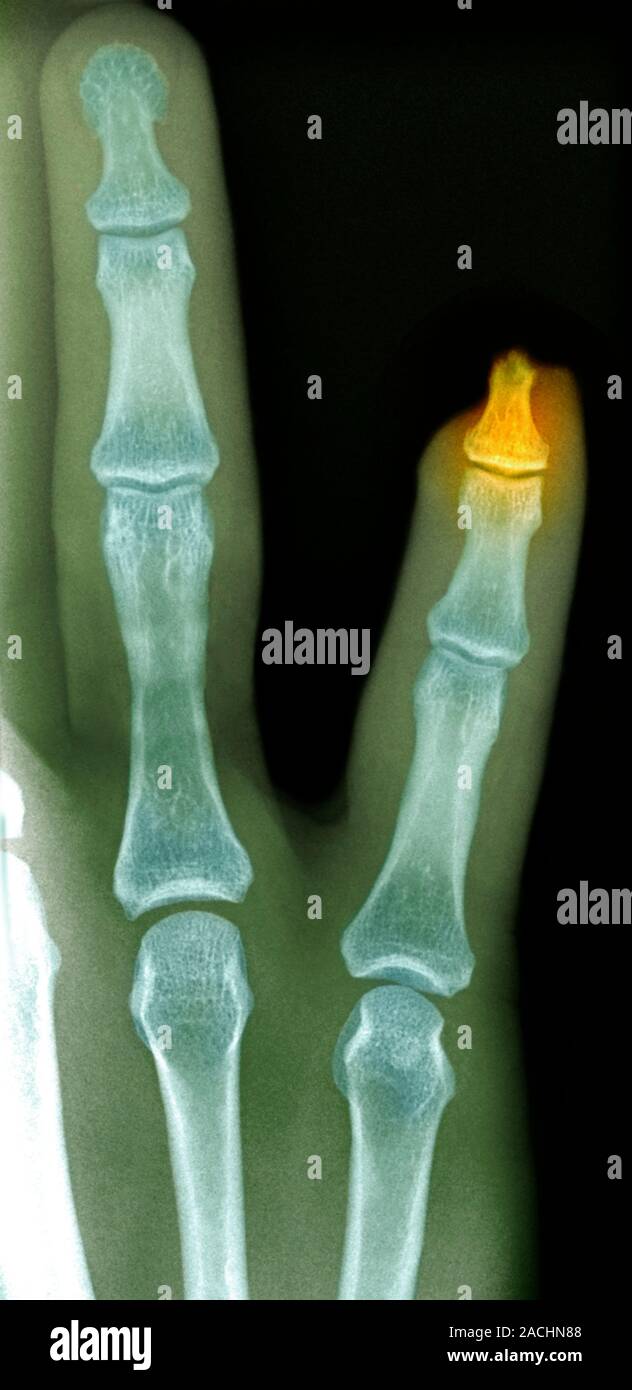 Amputated fingertip. Coloured X-ray of the 4th and 5th fingers of a ...