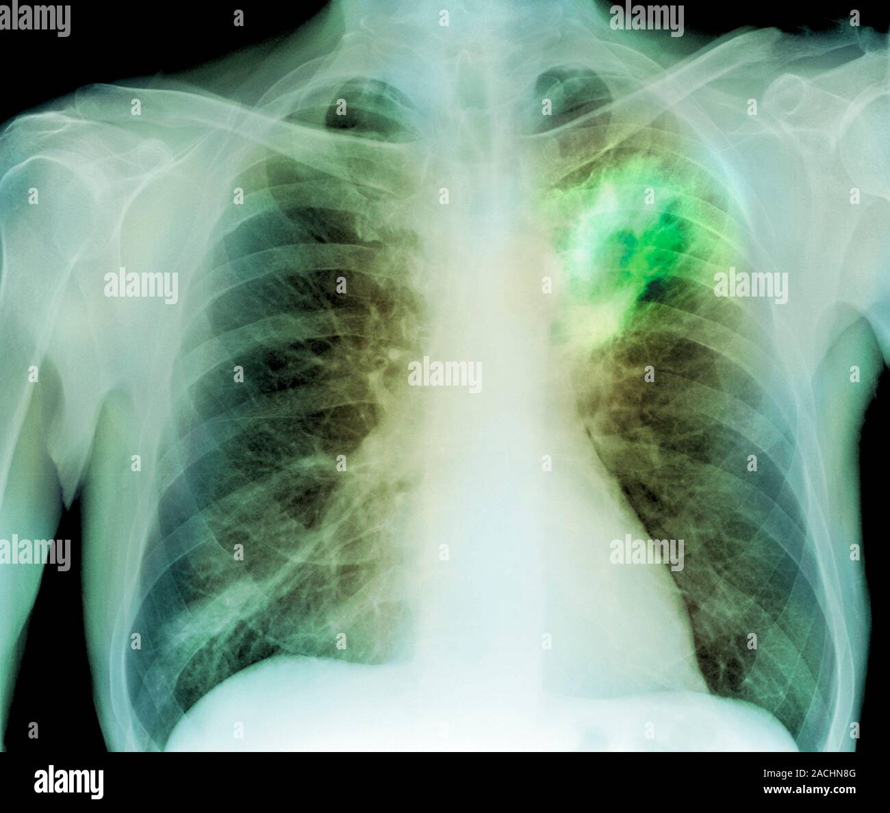 Lung abscess. Coloured X-ray showing an abscess (dense coloured area ...