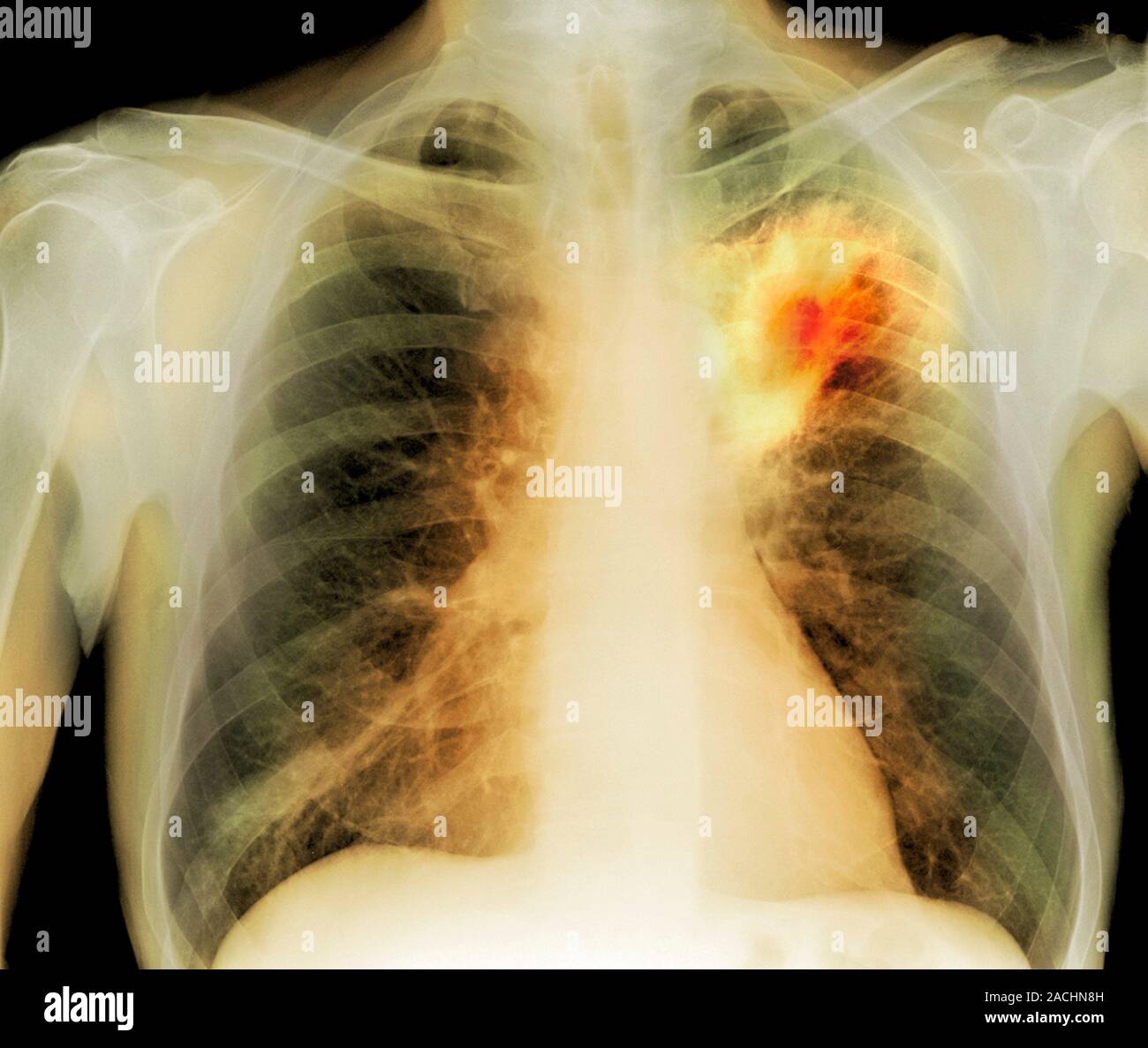 Lung abscess. Coloured X-ray showing an abscess (dense coloured area ...