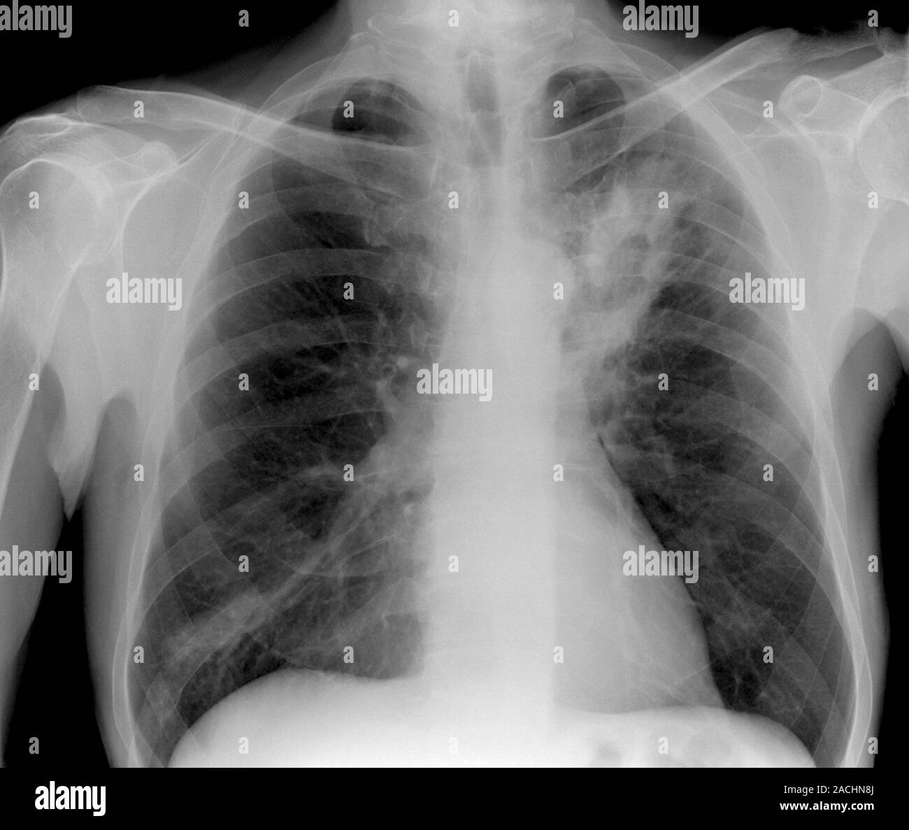 Lung abscess. X-ray showing an abscess (dense white area, upper right ...
