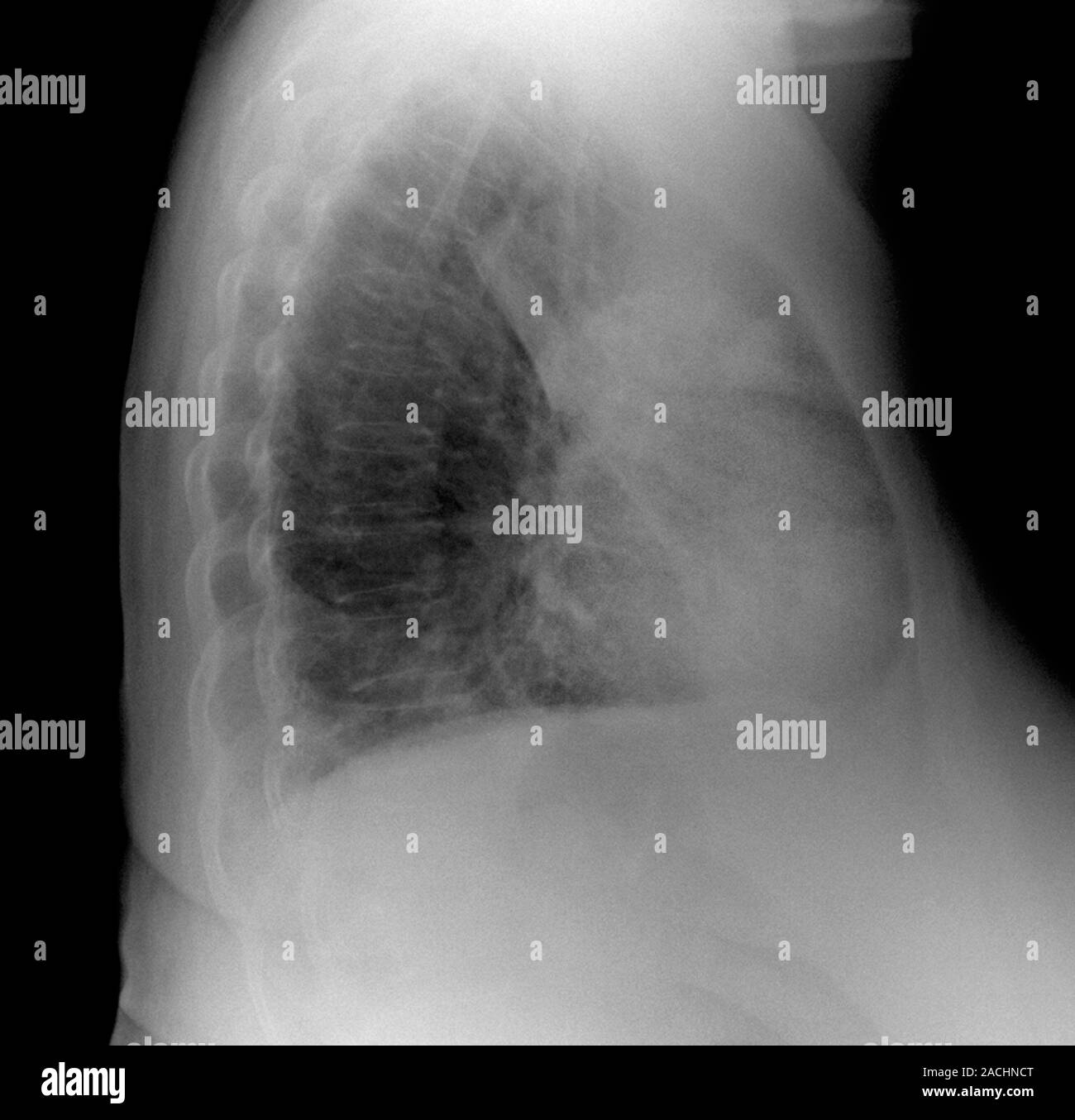 Pulmonary consolidation. X-ray showing that the upper lobe of a patient ...