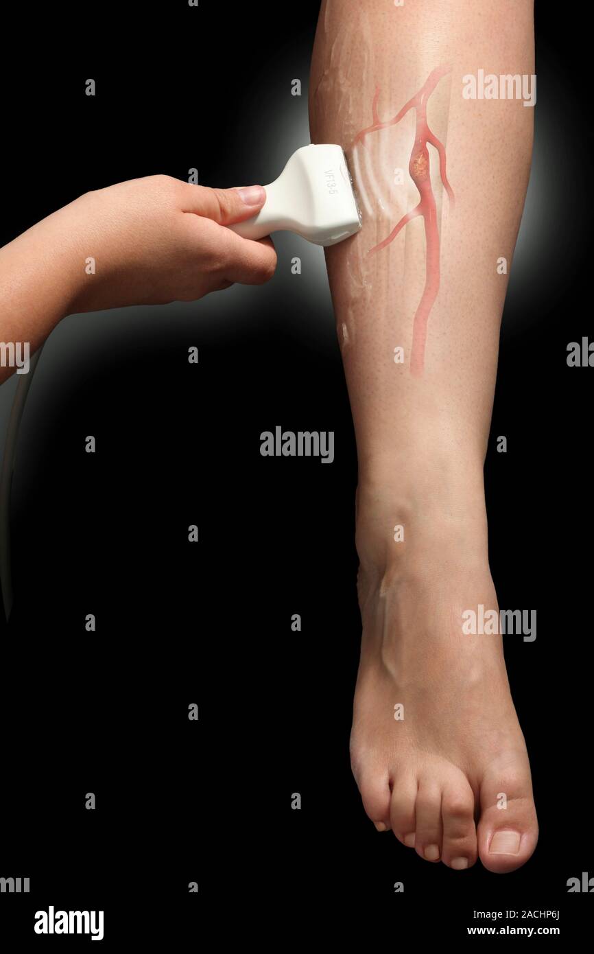 Ultrasound DVT scanning. Composite image of a radiologist's hand using ...