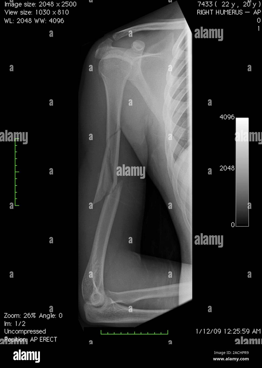 Broken arm bone. Digital frontal X-ray of the fractured right humerus ...