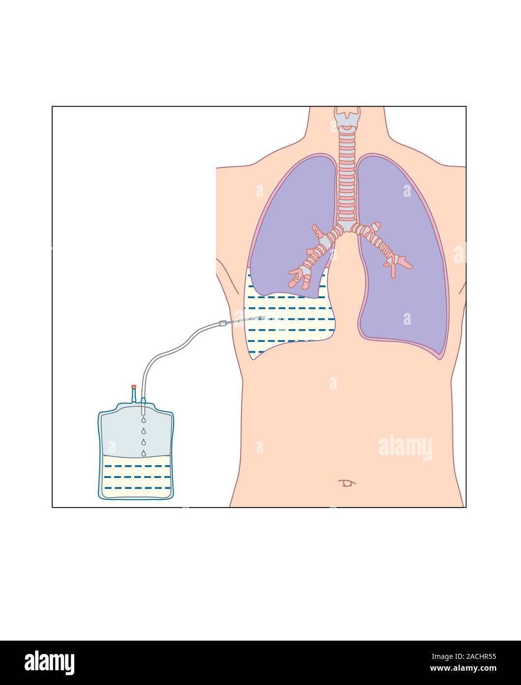 Pleural effusion treatment. Artwork of fluid being drained from around ...