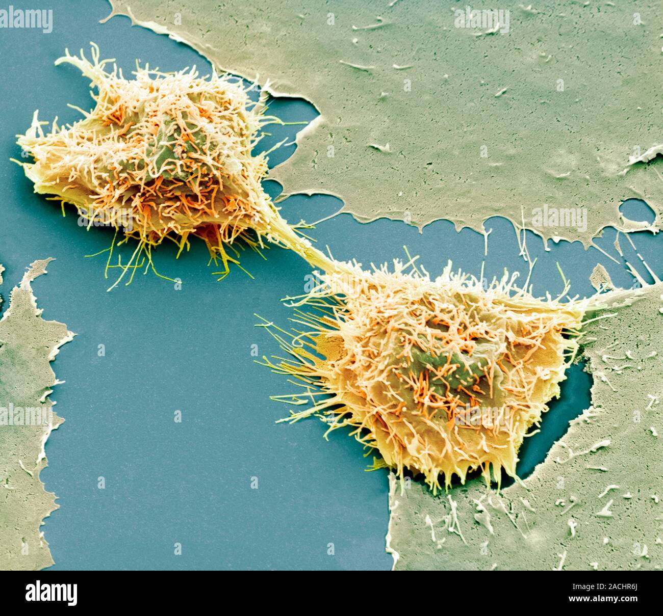 Dividing HeLa cells. Coloured scanning electron micrograph (SEM) of ...