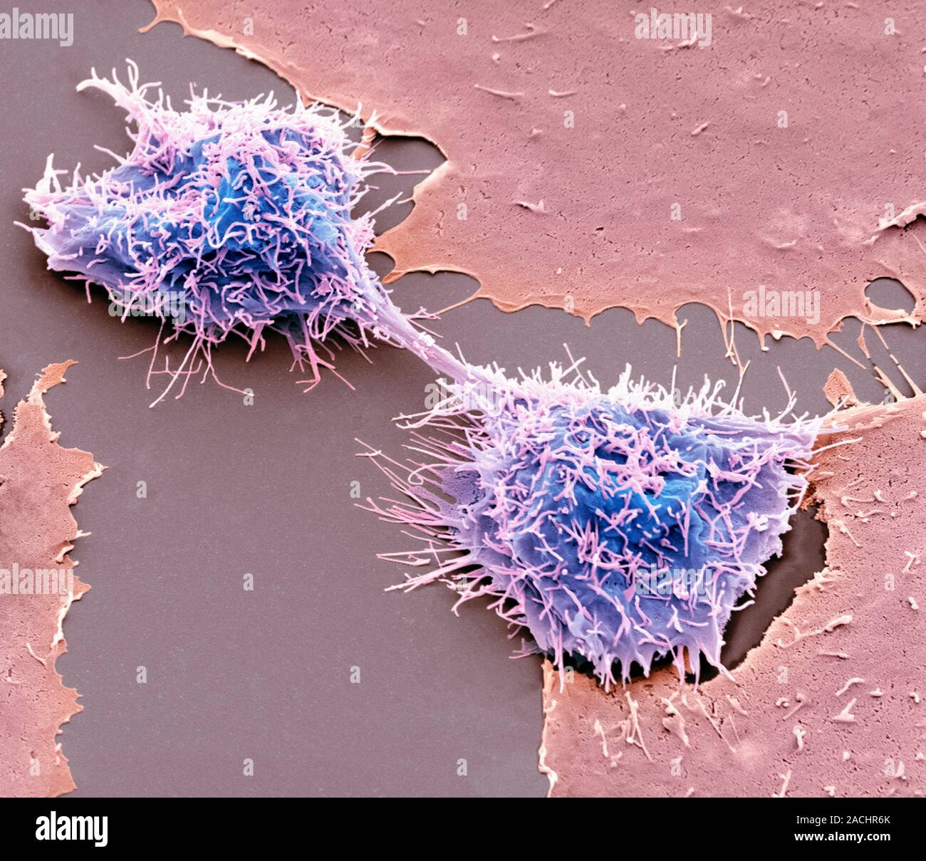 Dividing HeLa cells. Coloured scanning electron micrograph (SEM) of ...