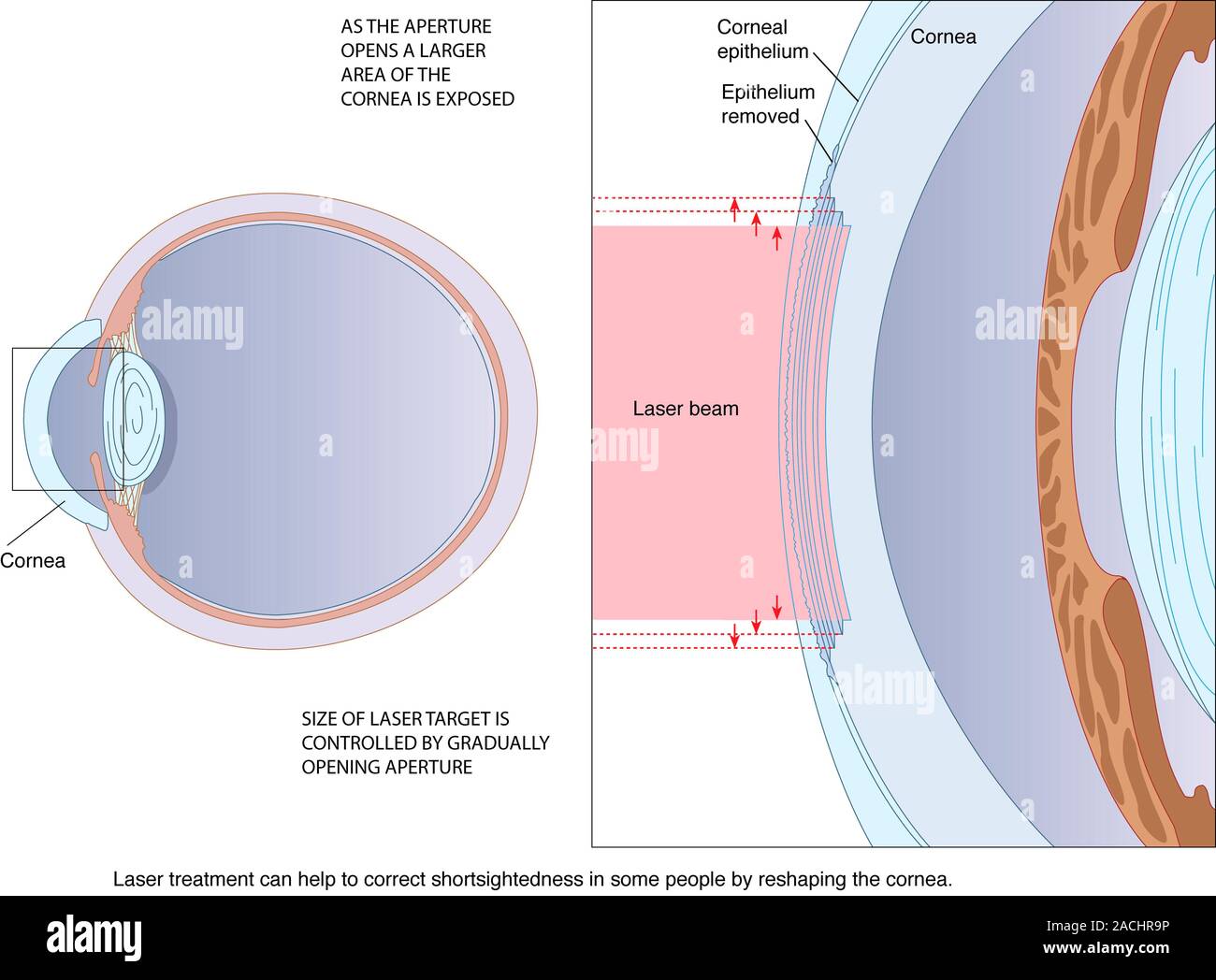 Laser eye surgery. Artwork showing how laser eye surgery is performed ...