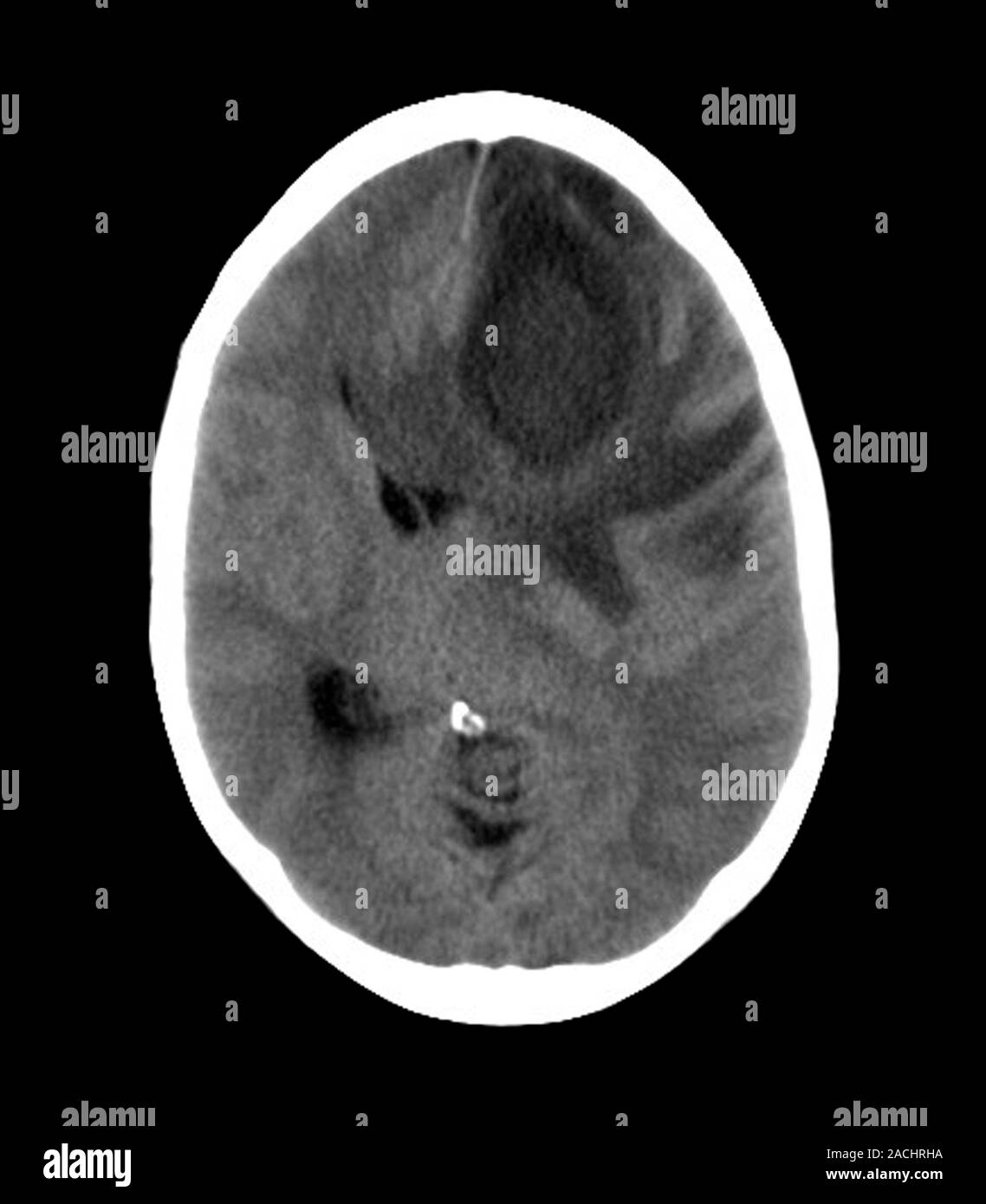 Brain abscess. Magnetic resonance imaging (MRI) scan of an axial ...