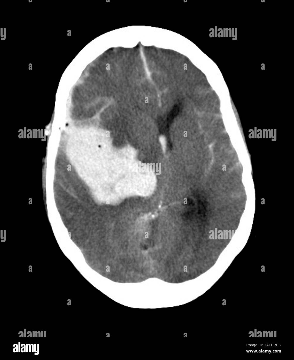 Subarachnoid haemorrhage. Magnetic resonance imaging (MRI) scan of an ...