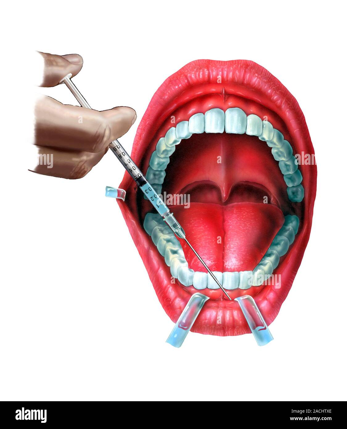 Dental anaesthesia. Computer artwork showing an anaesthetic being ...