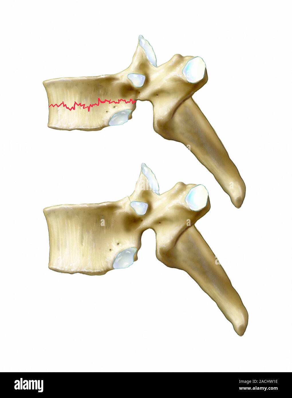 Compression fracture. Computer artwork showing a normal vertebra ...
