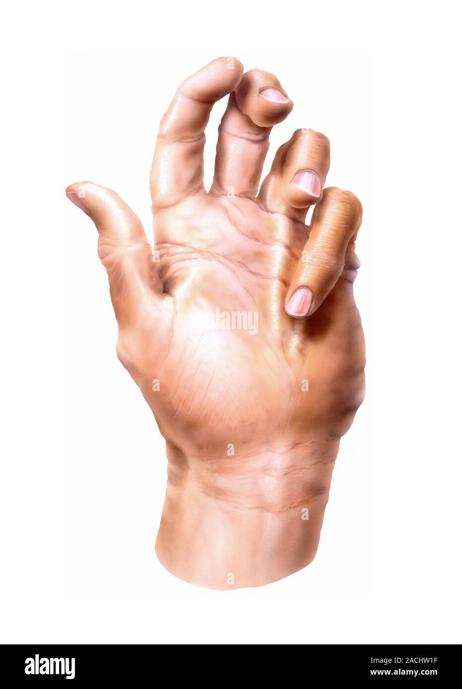 Dupuytren's contracture. Computer artwork of a hand with Dupuytren's ...