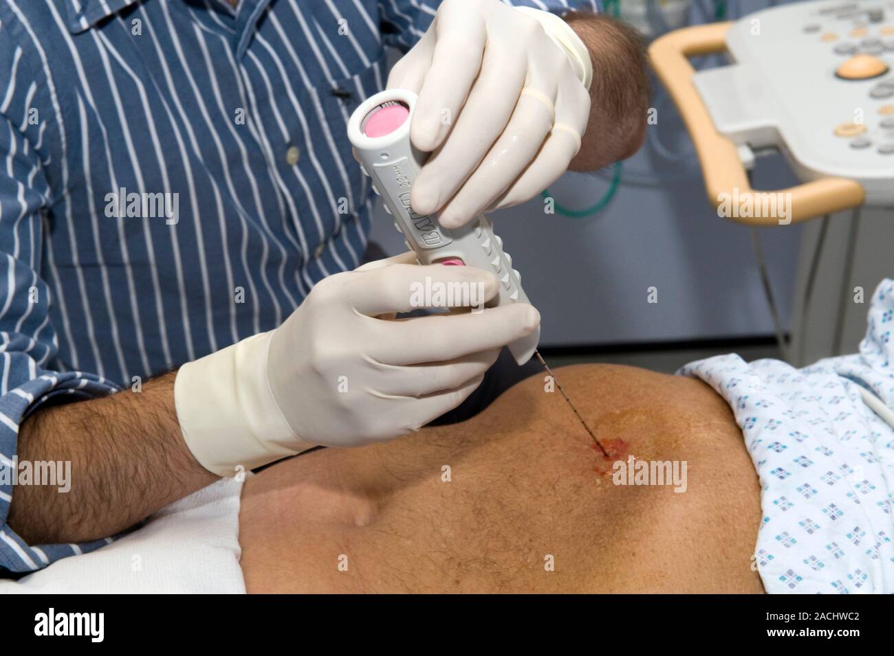 Percutaneous liver biopsy. Doctor using a long needle inserted through ...