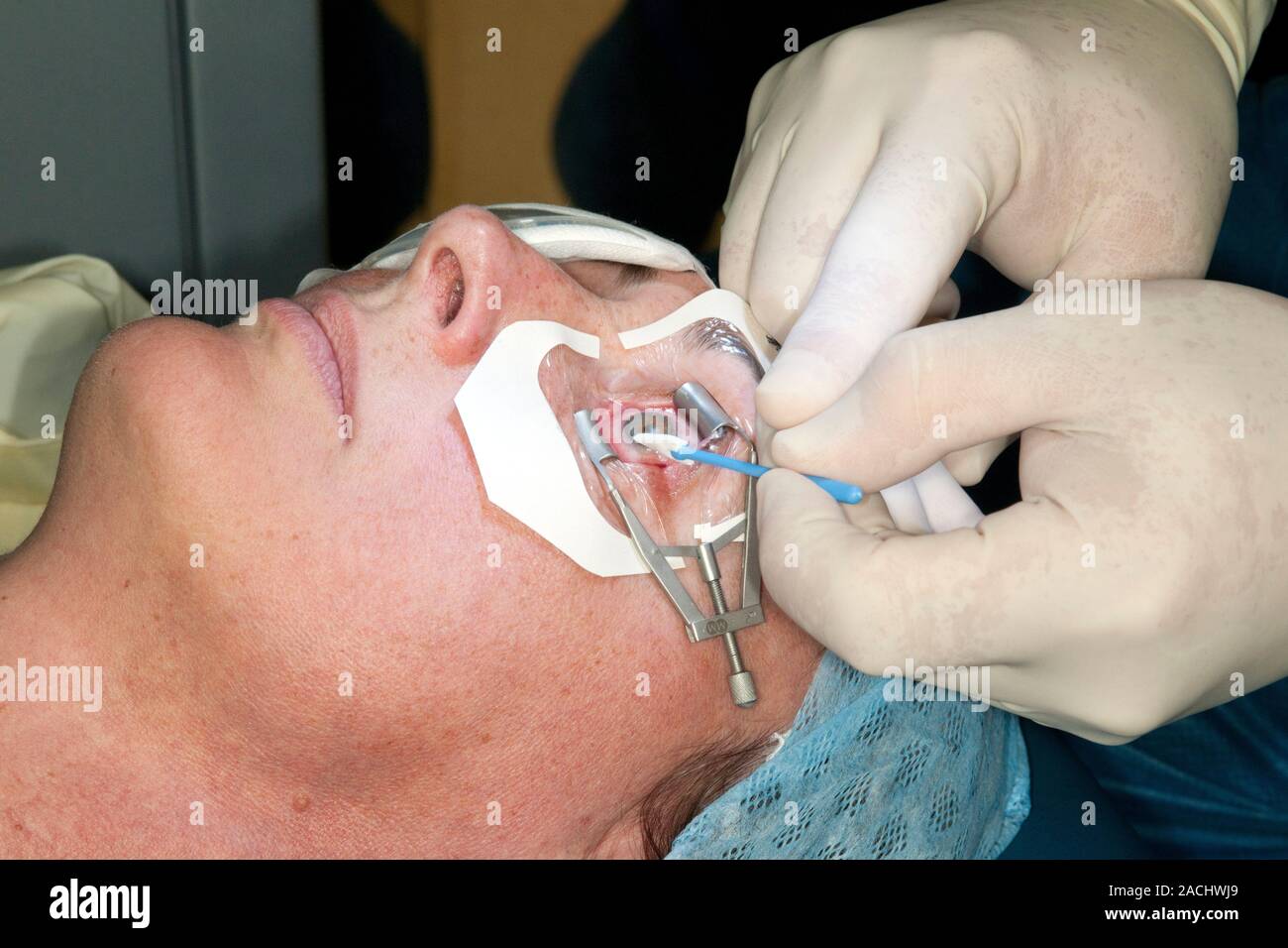 Laser eye surgery. Patient's eyes being prepared for excimer laser ...