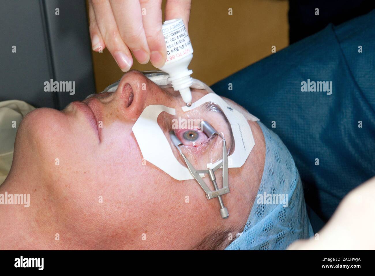 Laser eye surgery. Patient's eyes being prepared for excimer laser ...