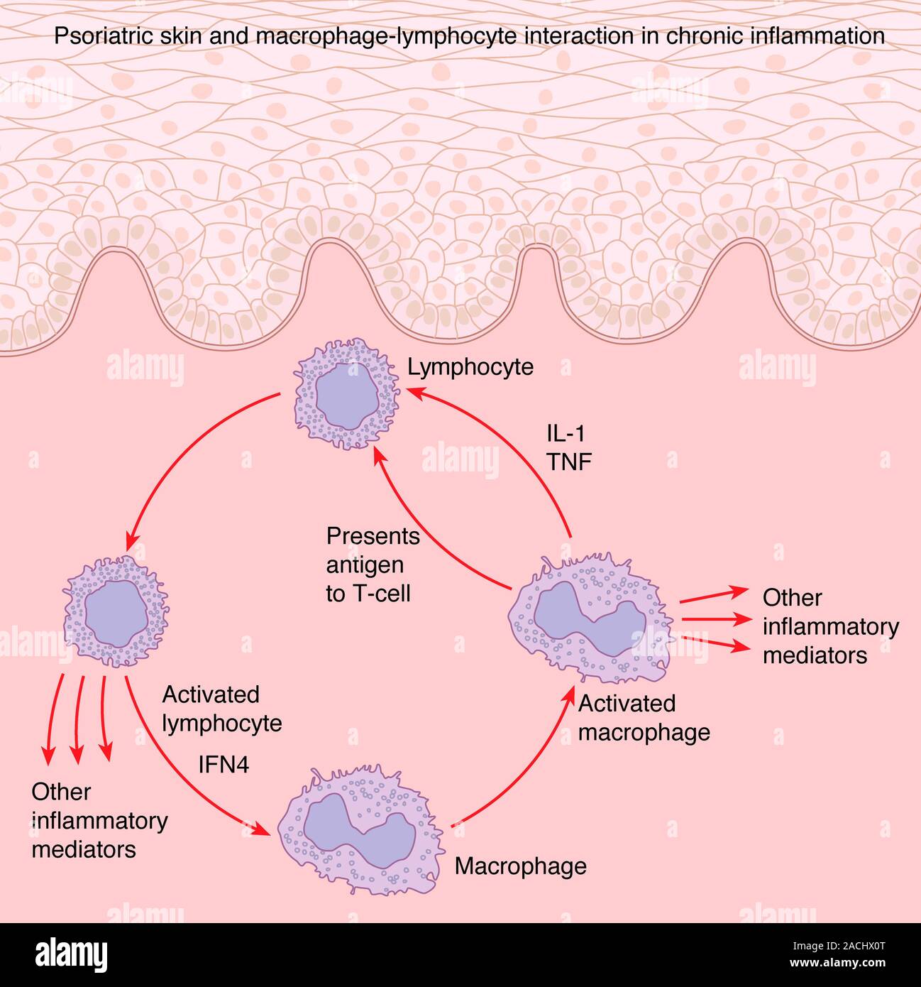 Immune response to chronic inflammation. Computer artwork showing the ...