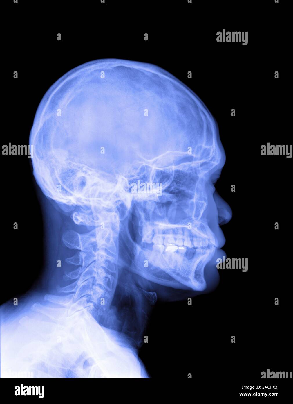 Human head. Coloured X-ray of an African man's head Stock Photo - Alamy