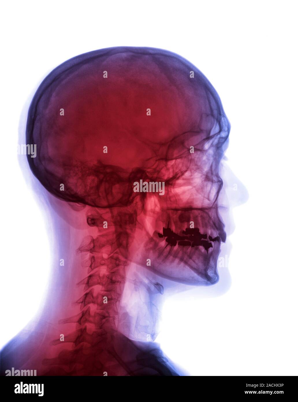 Human head. Coloured X-ray of a Caucasian man's head Stock Photo - Alamy