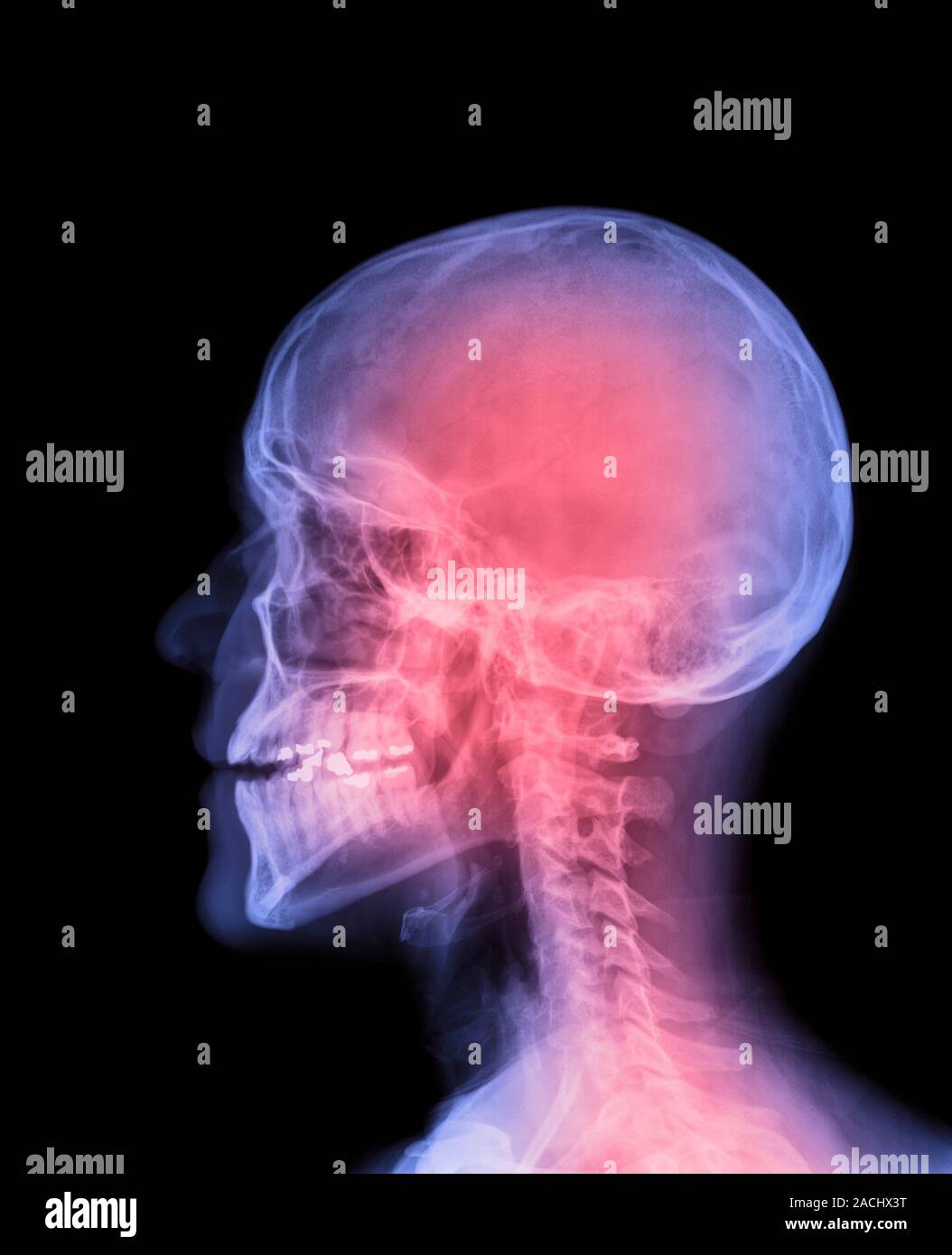 Human head. Coloured X-ray of a Caucasian man's head Stock Photo - Alamy
